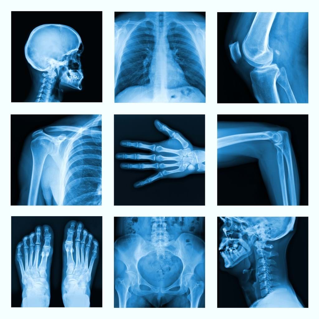 A new approach to bone injuries (Day 101) - IChemE